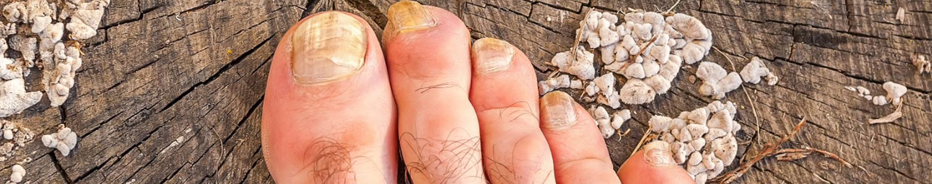 Fungal Nail Infection (Onychomycosis) | East Gosford Podiatry
