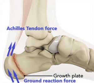 Severs Disease | East Gosford Podiatry