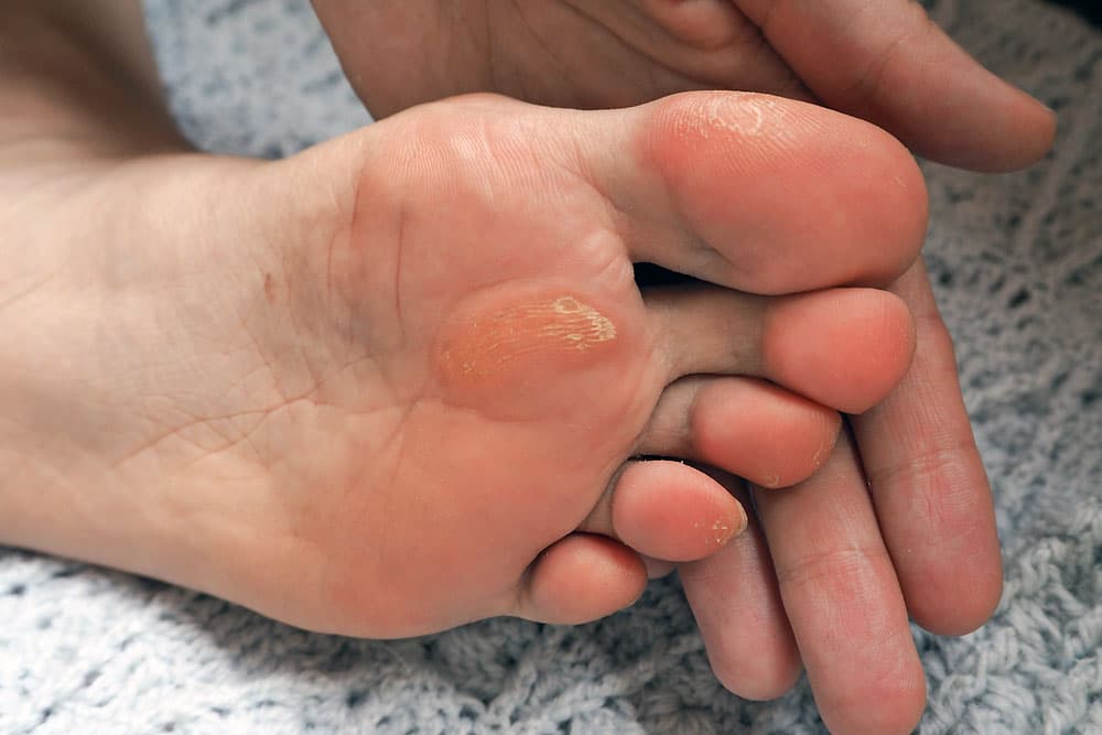 Corns and Calluses Treatment | East Gosford Podiatry