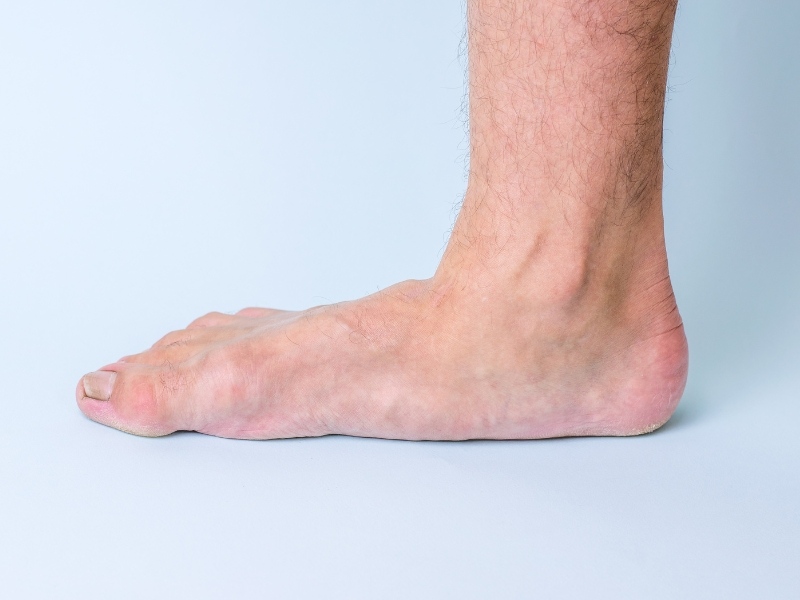 Structural Foot Deformities | Common Foot Conditions