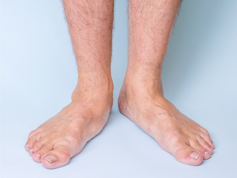 Flat Feet (Pes Planus) | East Gosford Podiatry